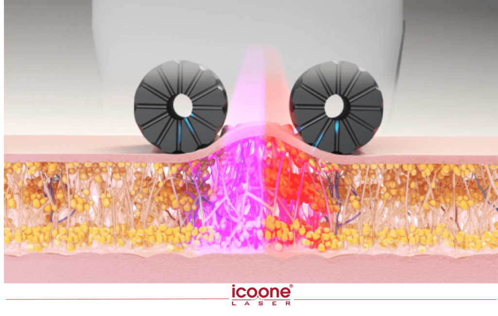 ICOONE® Laser – Fontaine de Jouvence